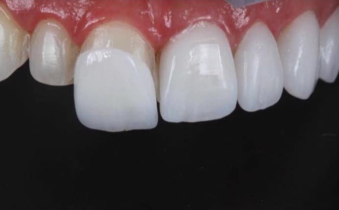 Facetas - Dra Danielle Freire